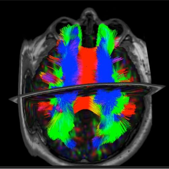 DTI in mTBI | Advanced Neuroimaging for Brain Injury | Neuro Experts